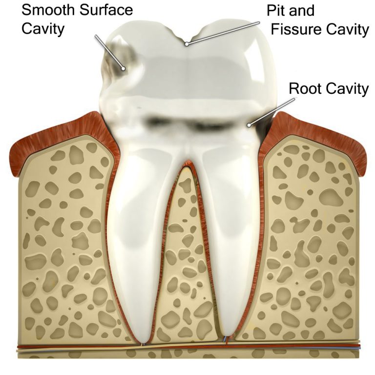 Gumline Cavity: Popular Causes, Symptoms and More