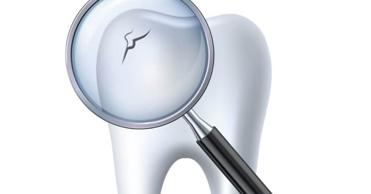 Cracked Tooth After Root Canal: 5 Things to Get Done ASAP